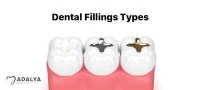 Dental Fillings Types: Which is Suitable For You? - Dental Clinic Turkey