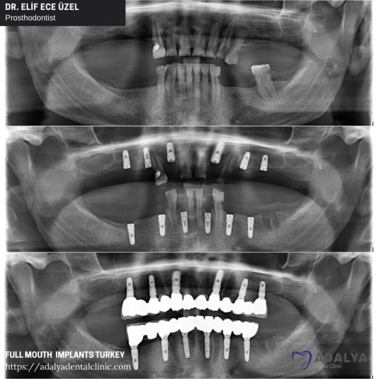 Full Mouth Dental Implants Turkey Package Deals: Full Set Implants Cost