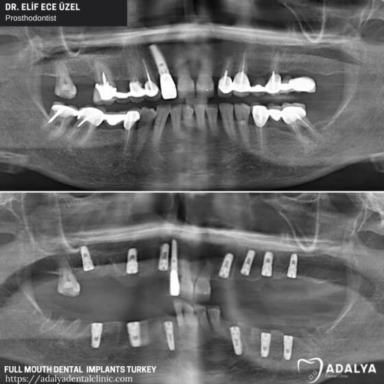 Full Mouth Dental Implants Turkey Package Deals: Full Set Implants Cost