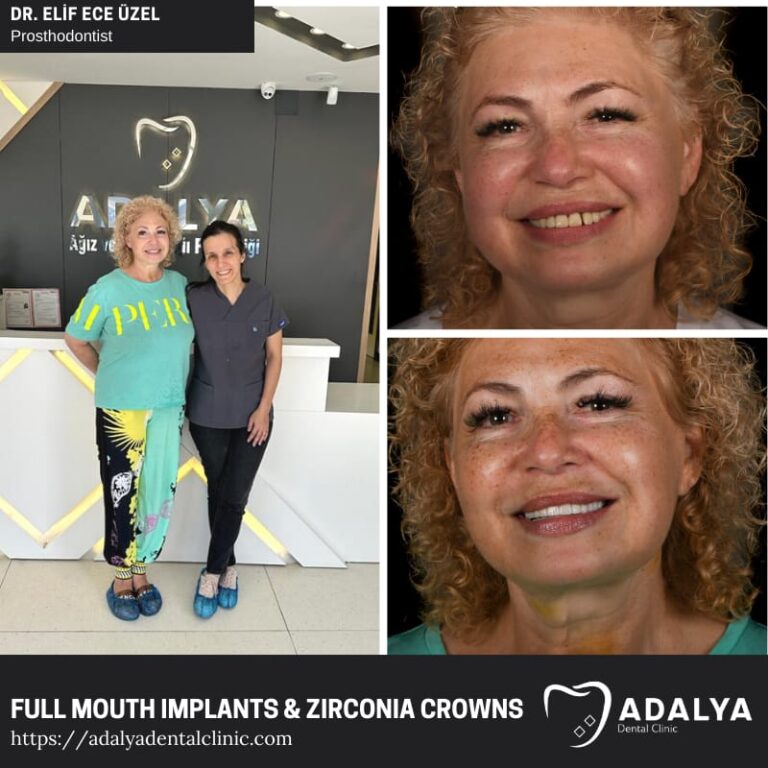 Full Mouth Dental Implants Turkey Package Deals: Full Set Implants Cost