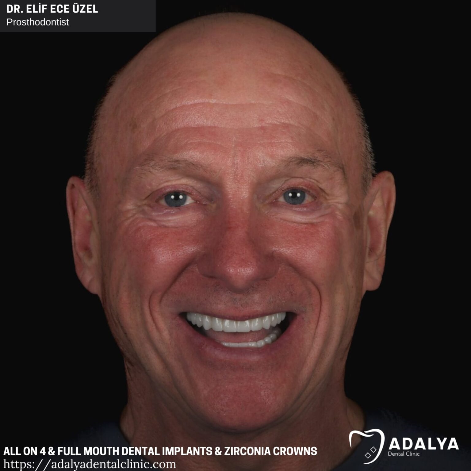 Full Mouth Dental Implants Turkey Package Deals: Full Set Implants Cost