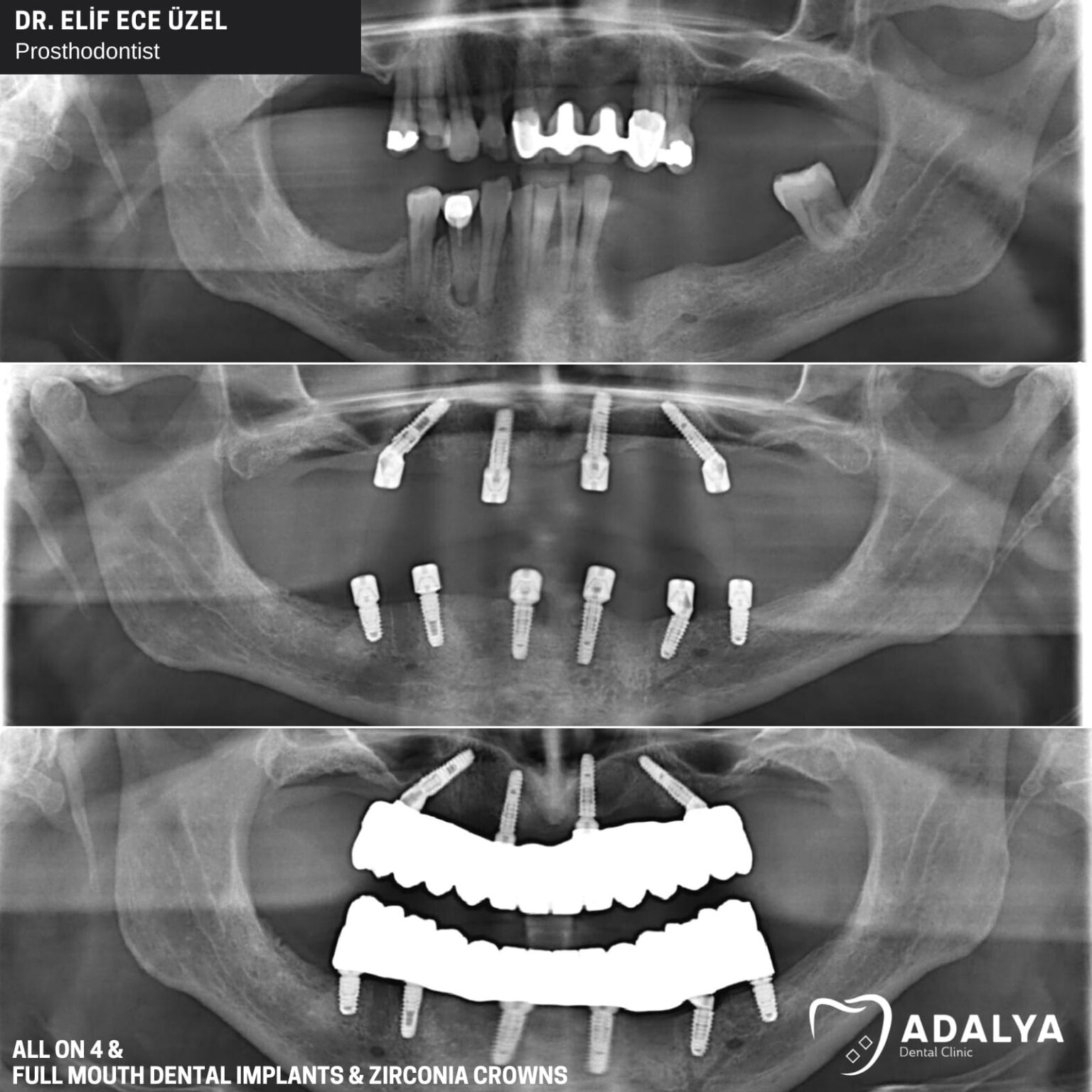 Full Mouth Dental Implants Turkey Package Deals: Full Set Implants Cost