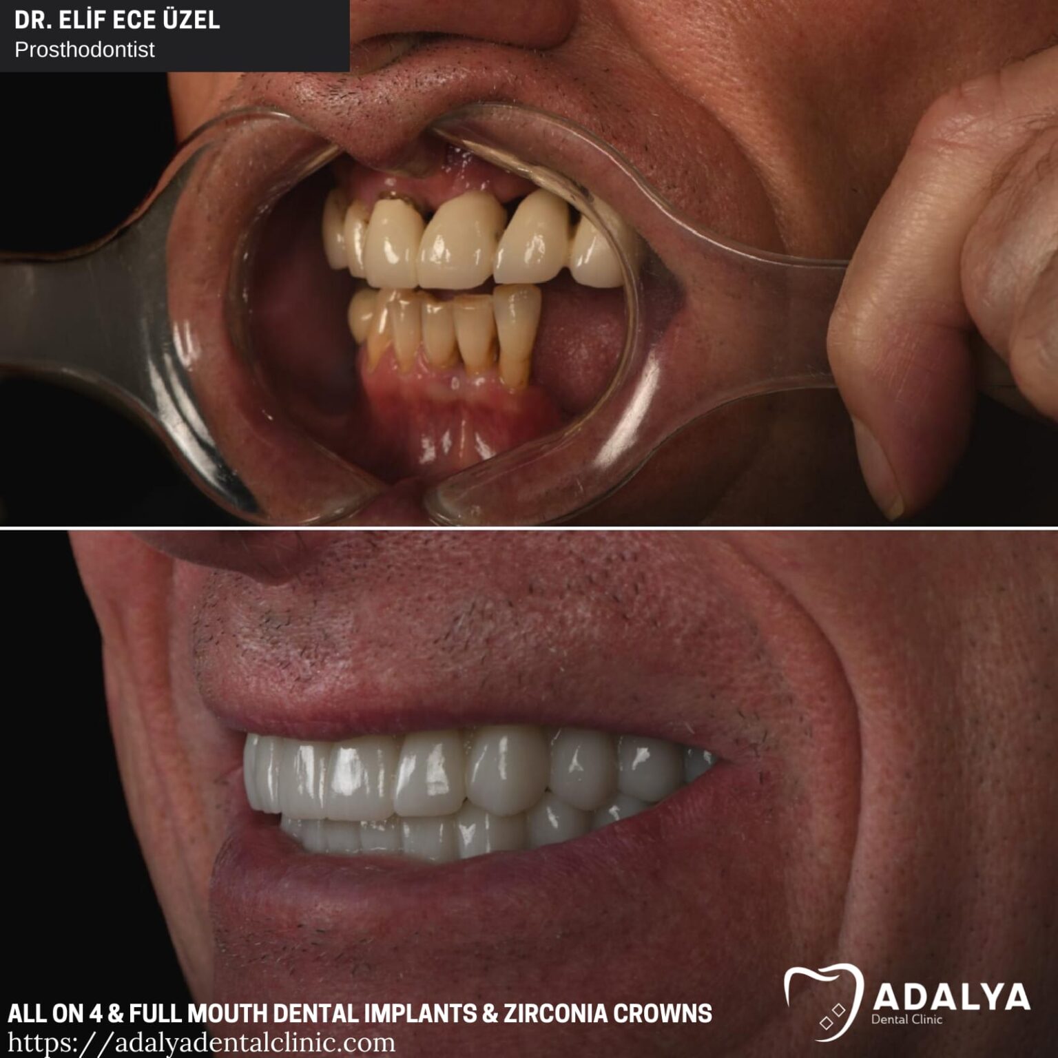 Full Mouth Dental Implants Turkey Package Deals: Full Set Implants Cost