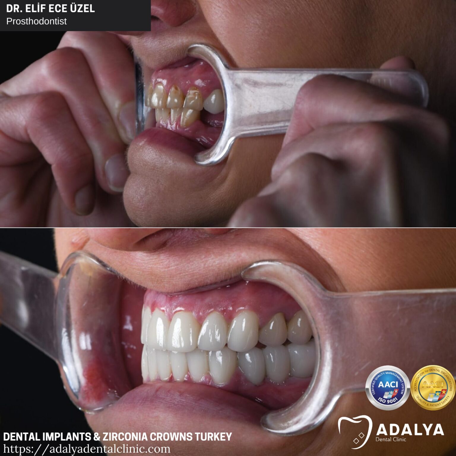 Dental Implants in Turkey, Antalya - Best Brands At Affordable Cost