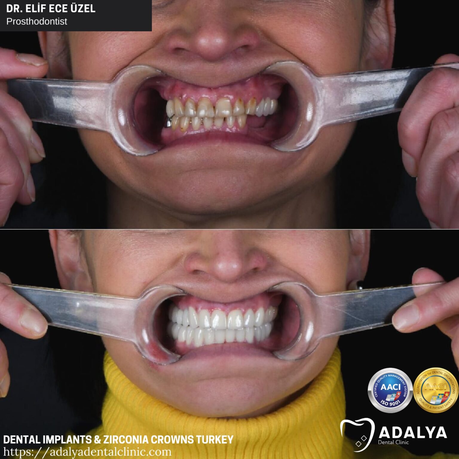 Dental Implants in Turkey, Antalya - Best Brands At Affordable Cost