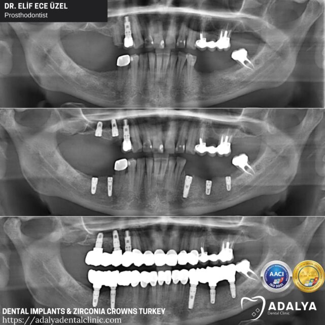 Dental Implants Turkey Antalya - Best Brands At Affordable Cost