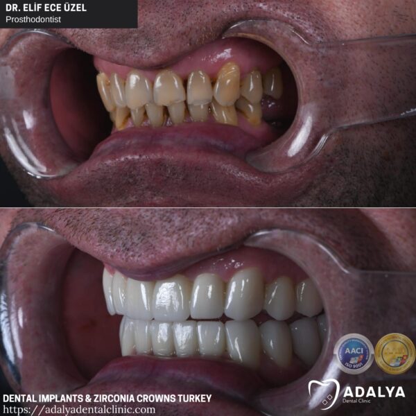 Dental Implants Turkey Antalya - Best Brands At Affordable Cost