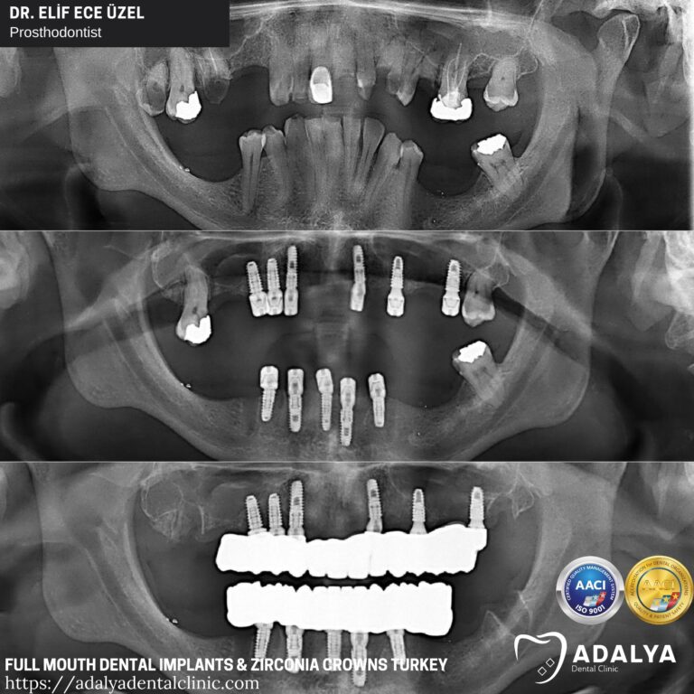 Full Mouth Dental Implants Turkey Package Deals: Full Set Implants Cost