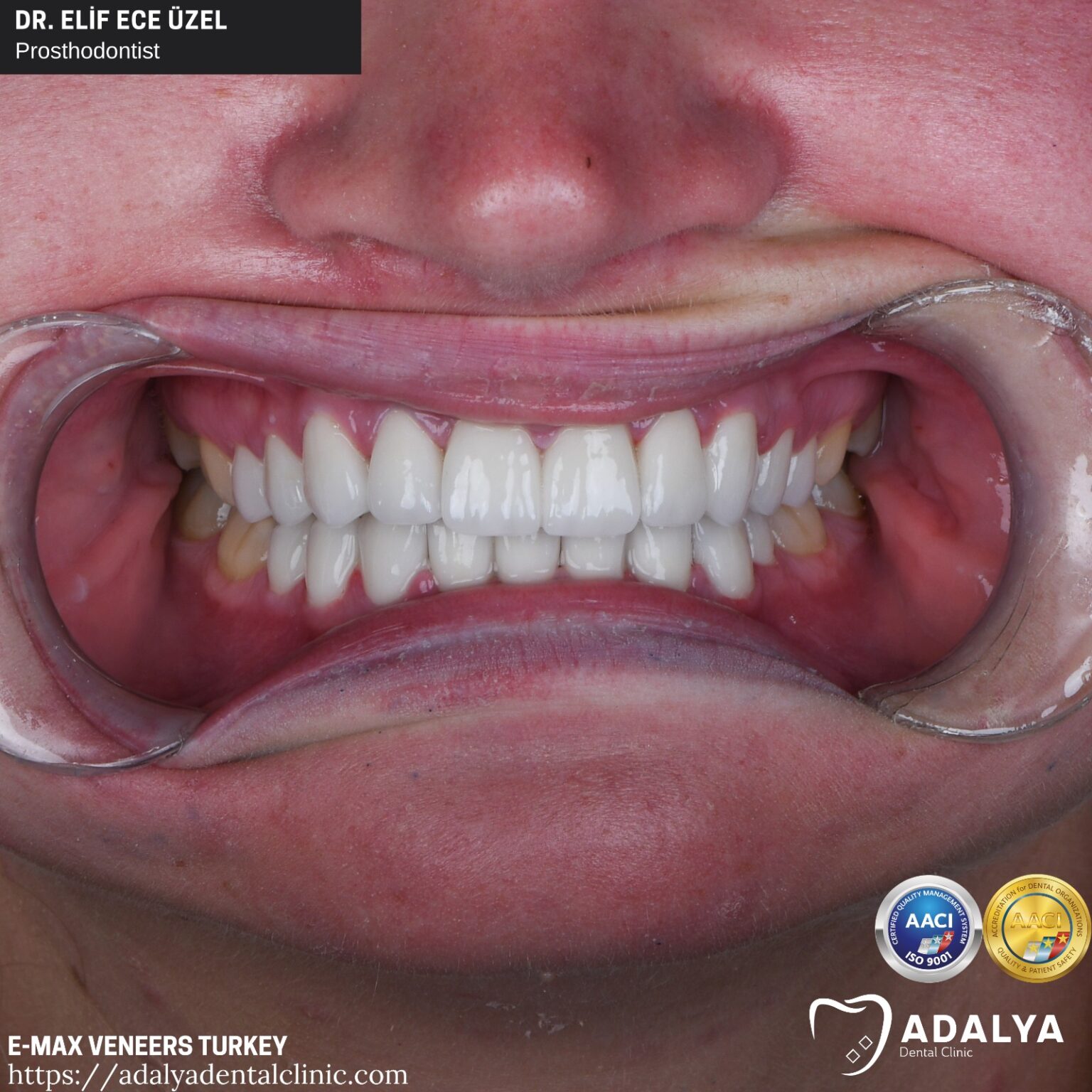Emax Crowns in Turkey - How is it Made? Cost, Advantages | Adalya