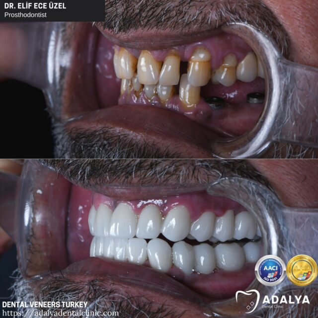 Dental Veneers Turkey: Cost, Porcelain, Price, Antalya, Packages