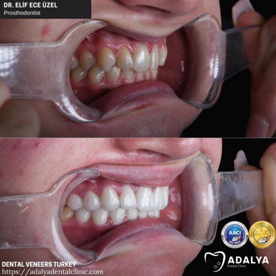 Dental Veneers Turkey: Cost 2024, Porcelain, Antalya, Packages