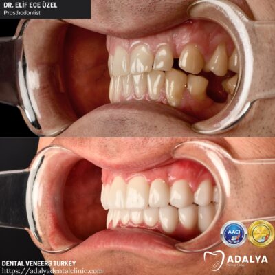 Dental Veneers Turkey: Cost, Porcelain, Price, Antalya, Packages