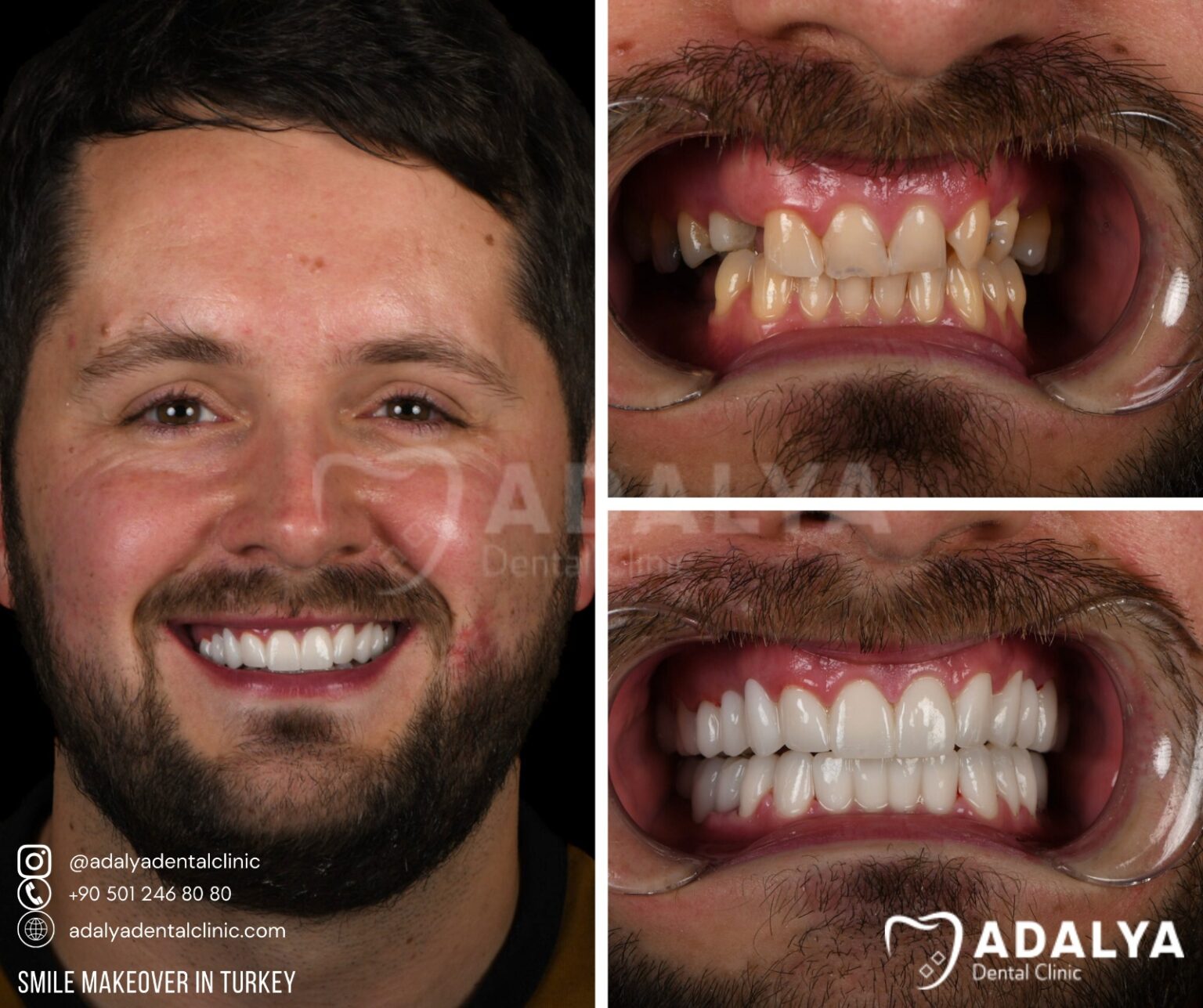 Smile Makeover Turkey - Affordable Cost in Turkey | Adalya Dental Clinic