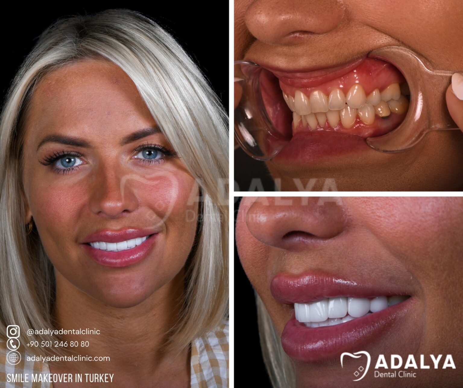 Smile Makeover Turkey - Affordable Cost in Turkey | Adalya Dental Clinic