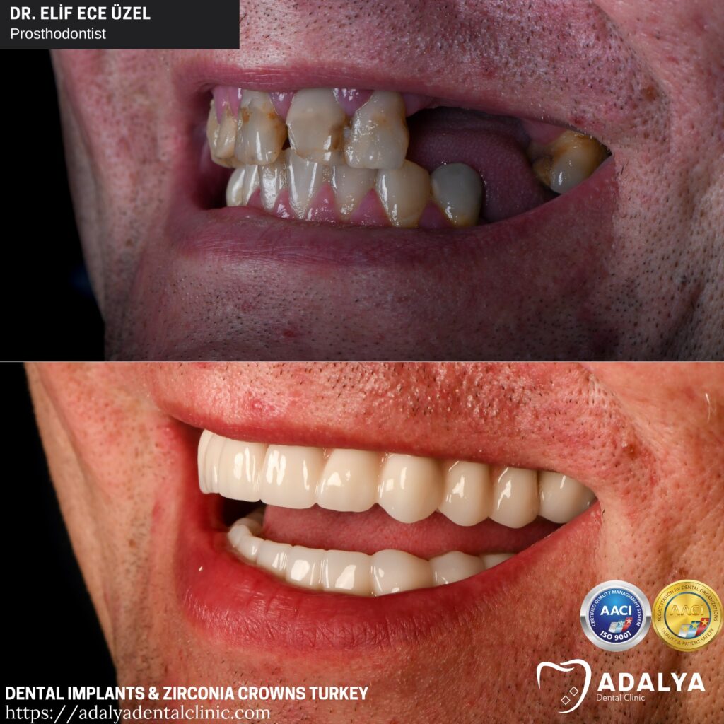 Dental Implants in Turkey, Antalya - Best Brands At Affordable Cost