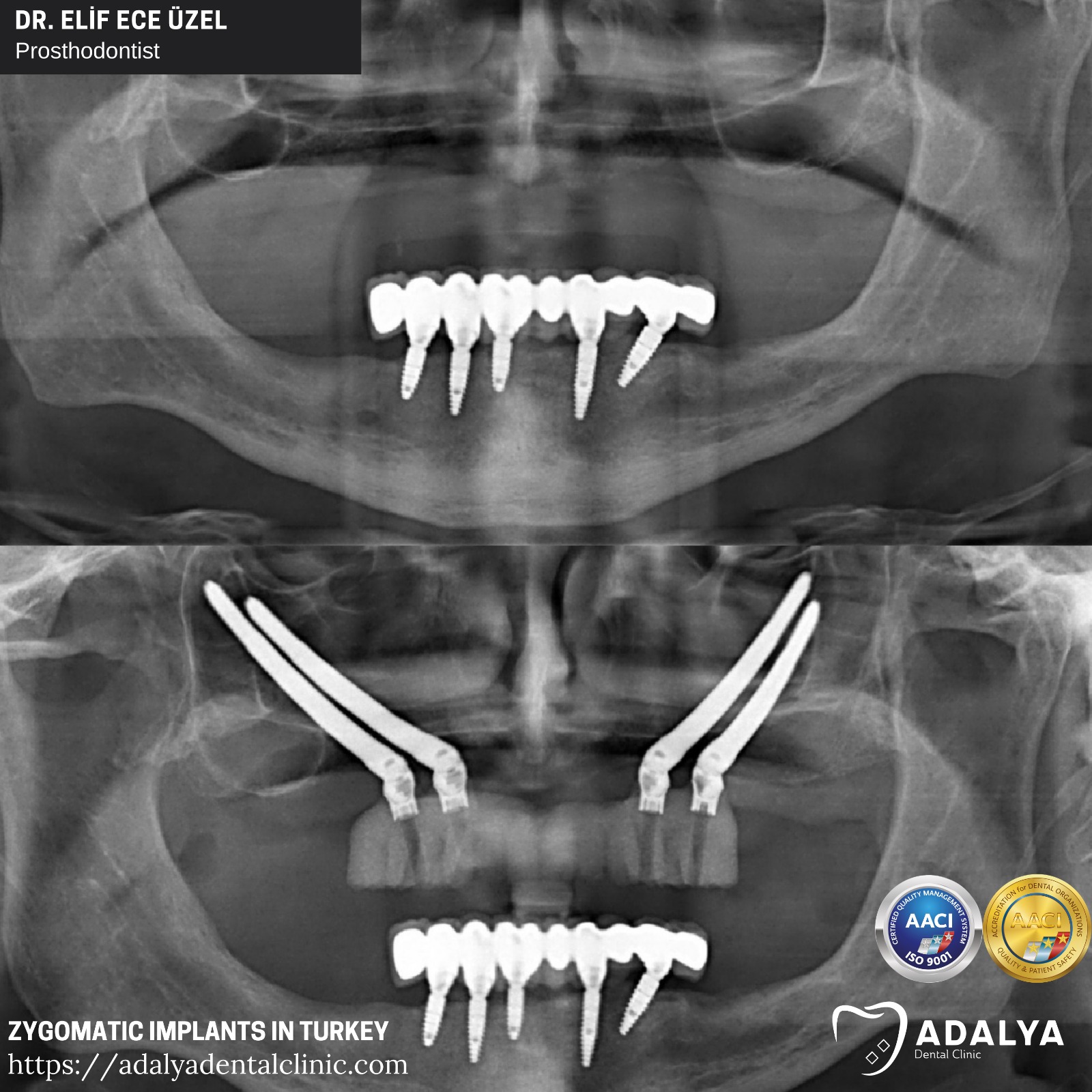 Zygomatic Implants Turkey: Cost 2024 & All Guideline
