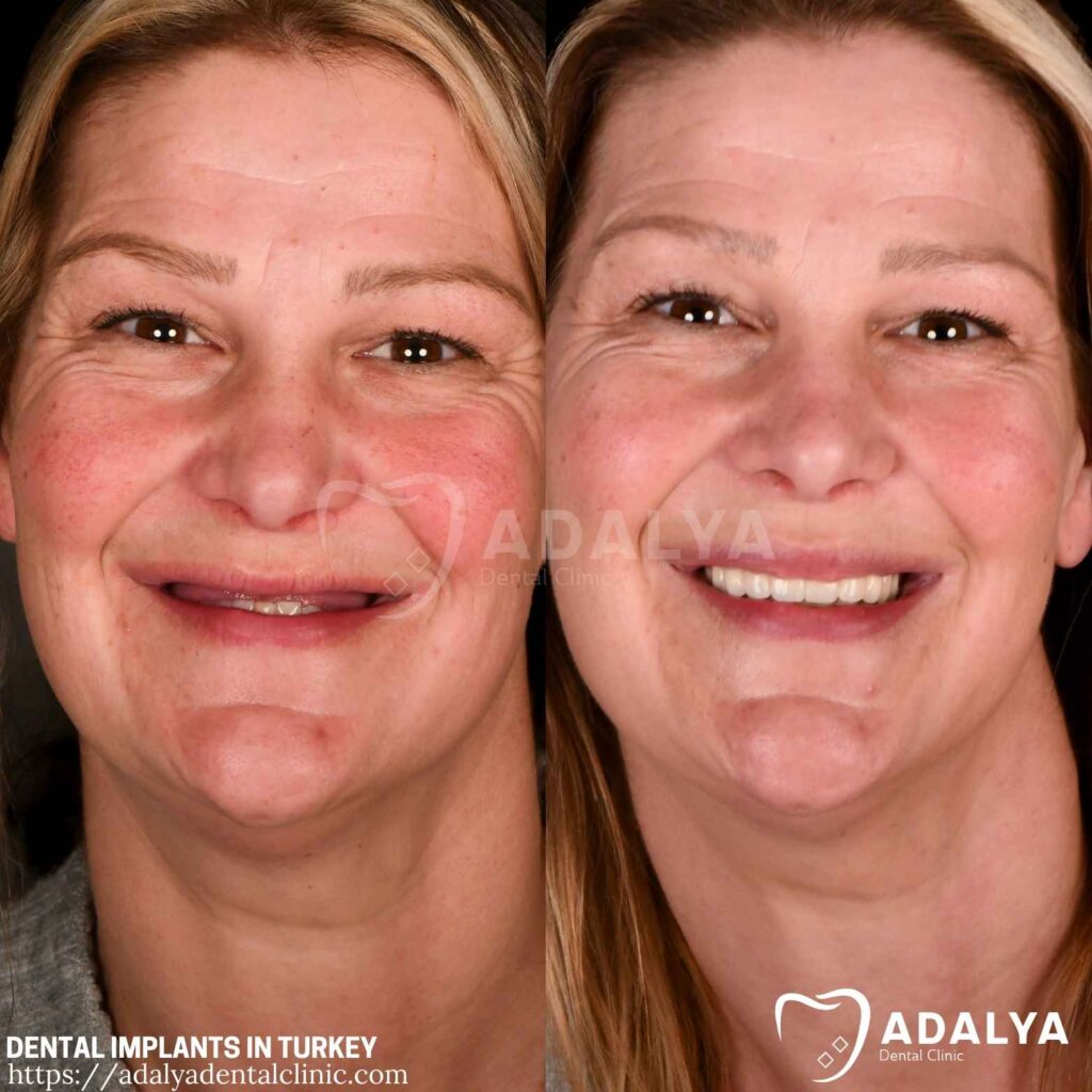 Tooth Implant Turkey Price 2025 - Affordable Tooth Implants Cost