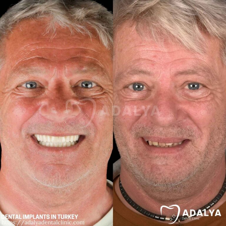 Tooth Implant Turkey Price 2025 - Affordable Tooth Implants Cost