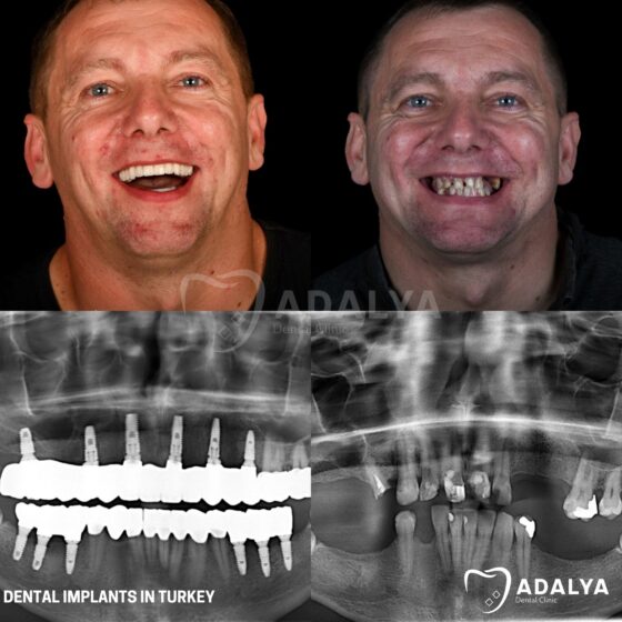 Tooth Implant Turkey Price 2025 - Affordable Tooth Implants Cost
