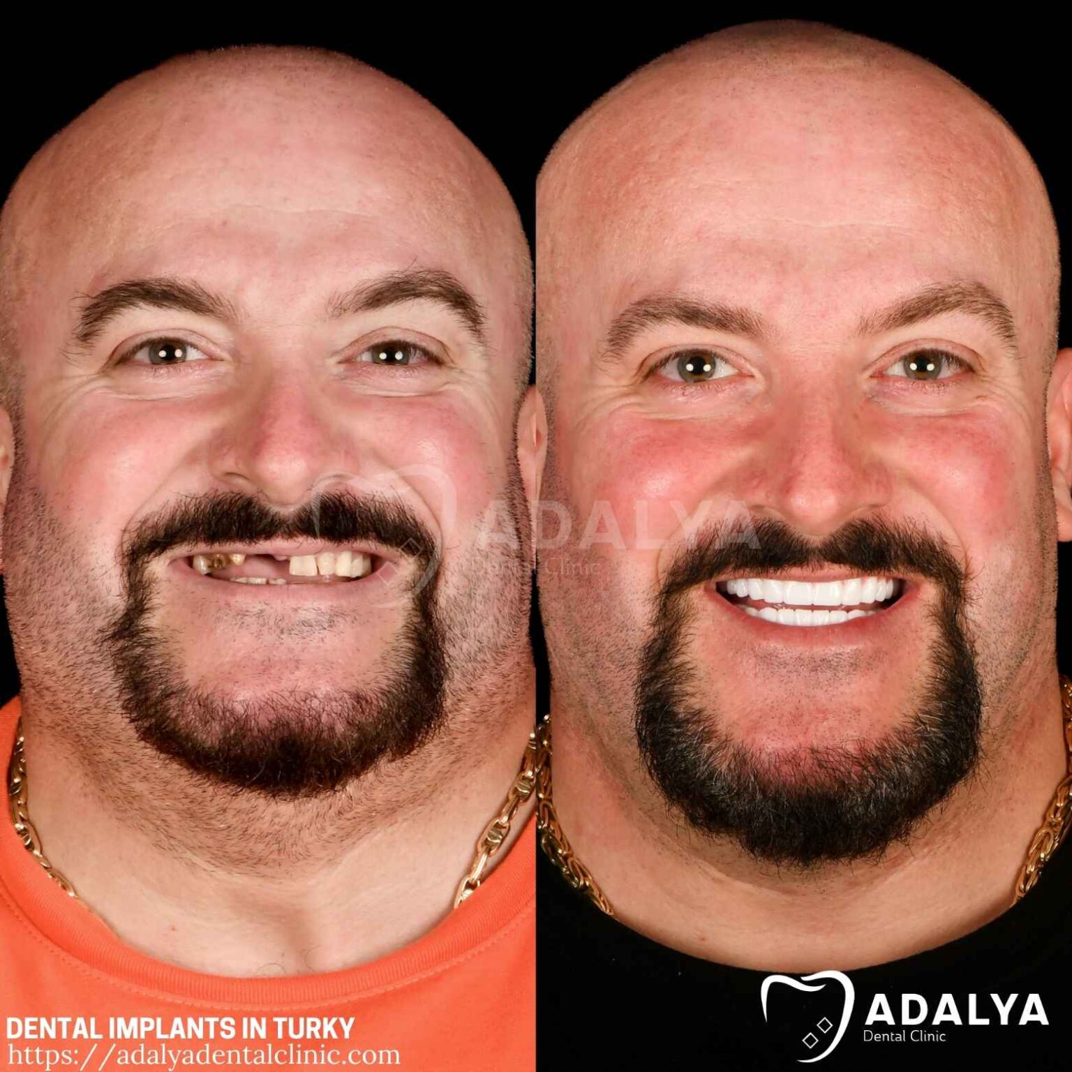 Tooth Implant Turkey Price 2025 - Affordable Tooth Implants Cost