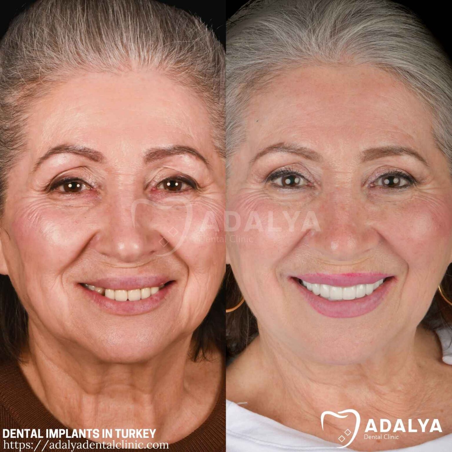 Tooth Implant Turkey Price 2025 - Affordable Tooth Implants Cost