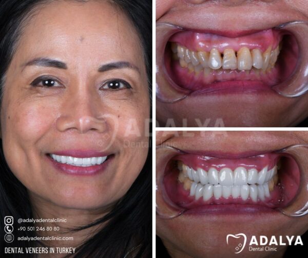 Turkey Teeth Veneers Before and After | Adalya Dental Clinic