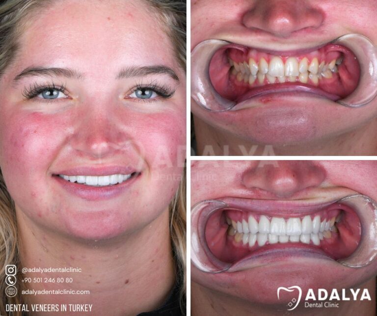 Turkey Teeth Veneers Before and After | Adalya Dental Clinic