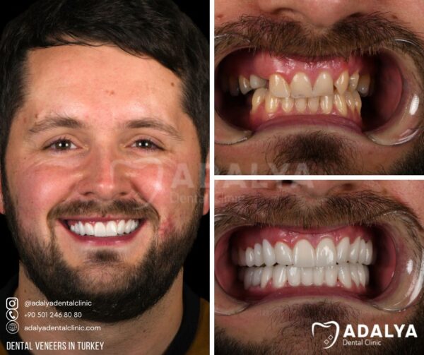 Turkey Teeth Veneers Before and After | Adalya Dental Clinic