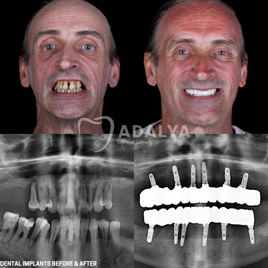 Dental Implants Before and After: Pictures & All Guideline