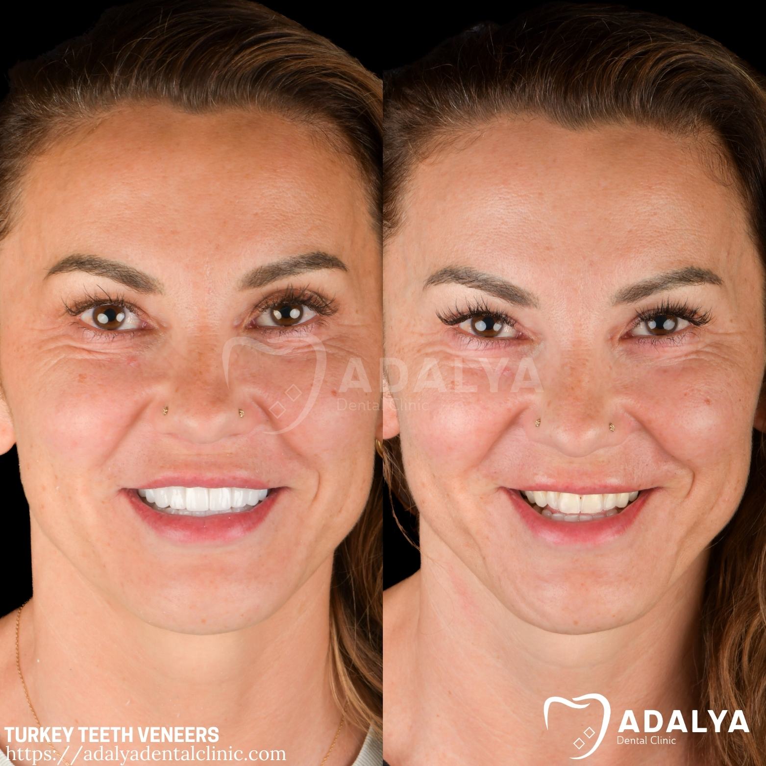 Turkish Teeth Veneers: Price Full Set, Turkey Packages, Reviews