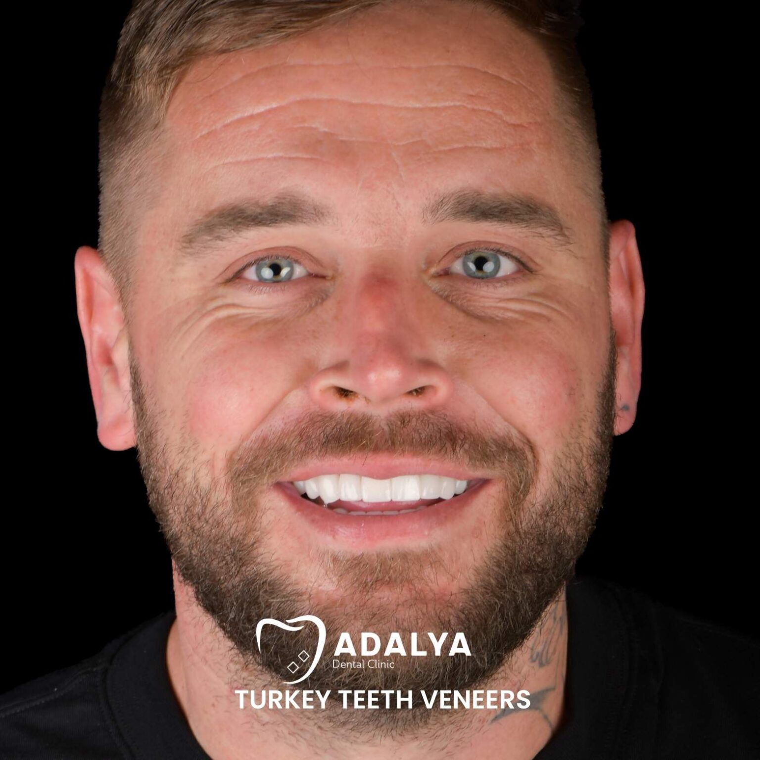 Turkey Teeth Veneers - Affordable Dental Veneer Price in Antalya