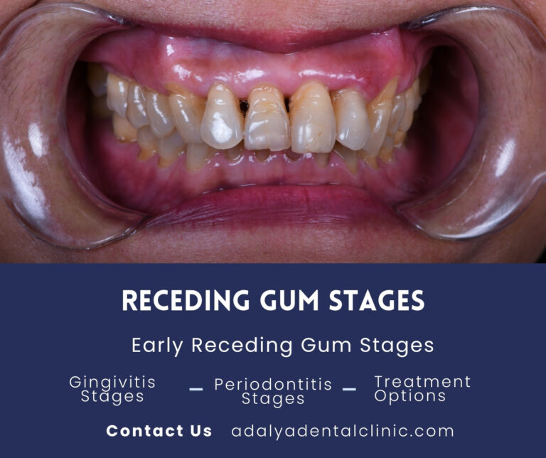 Receding Gum Stages - Early Receding Gums Stages | Adalya