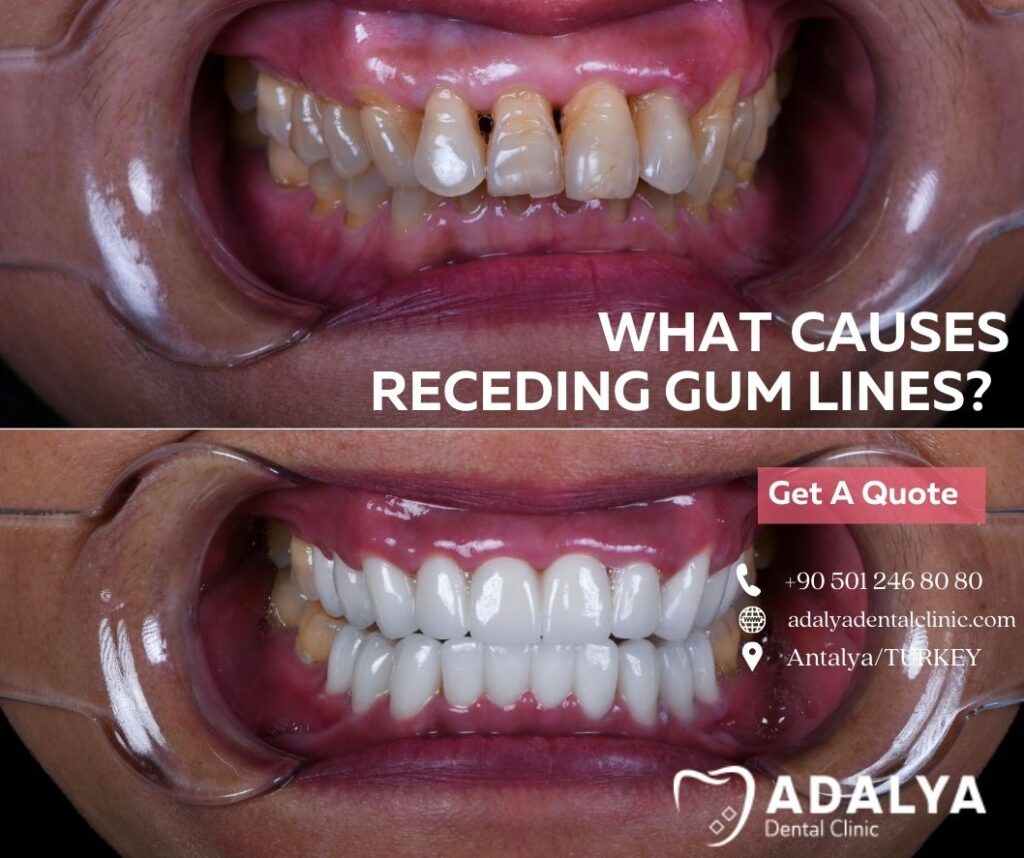 Receding Gum Line Causes - How to Fix Receding Gums