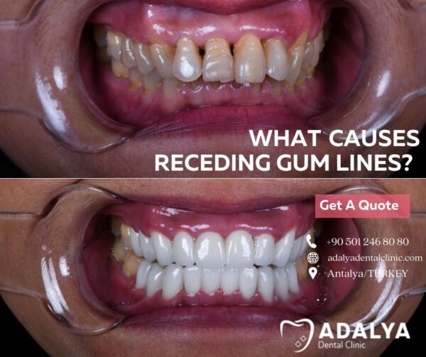 Receding Gum Line Causes - How to Fix Receding Gums