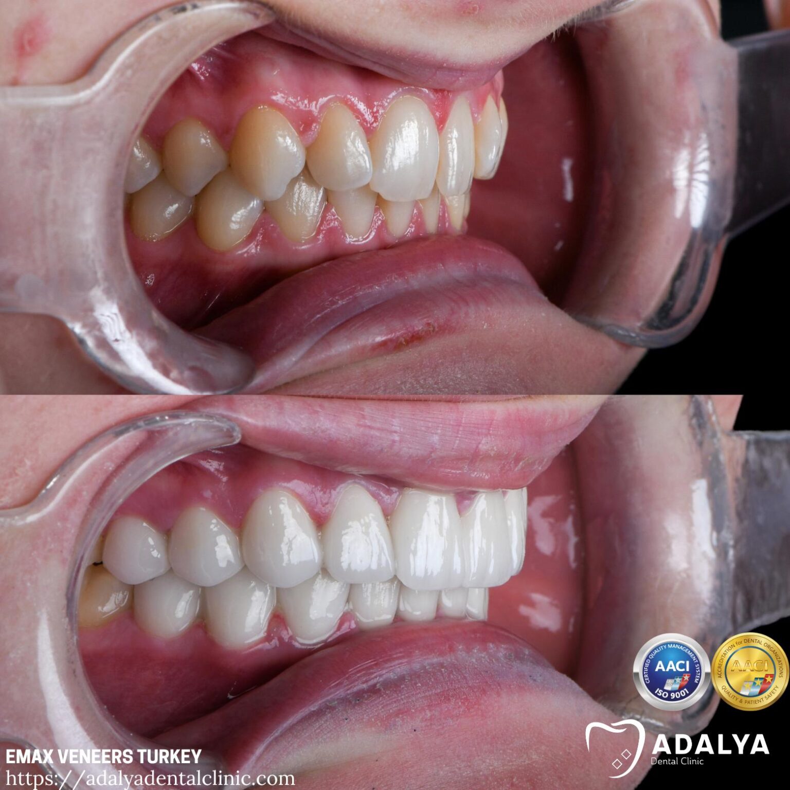 Emax Veneers Turkey Price 2025 - High Quality Veneer in Antalya