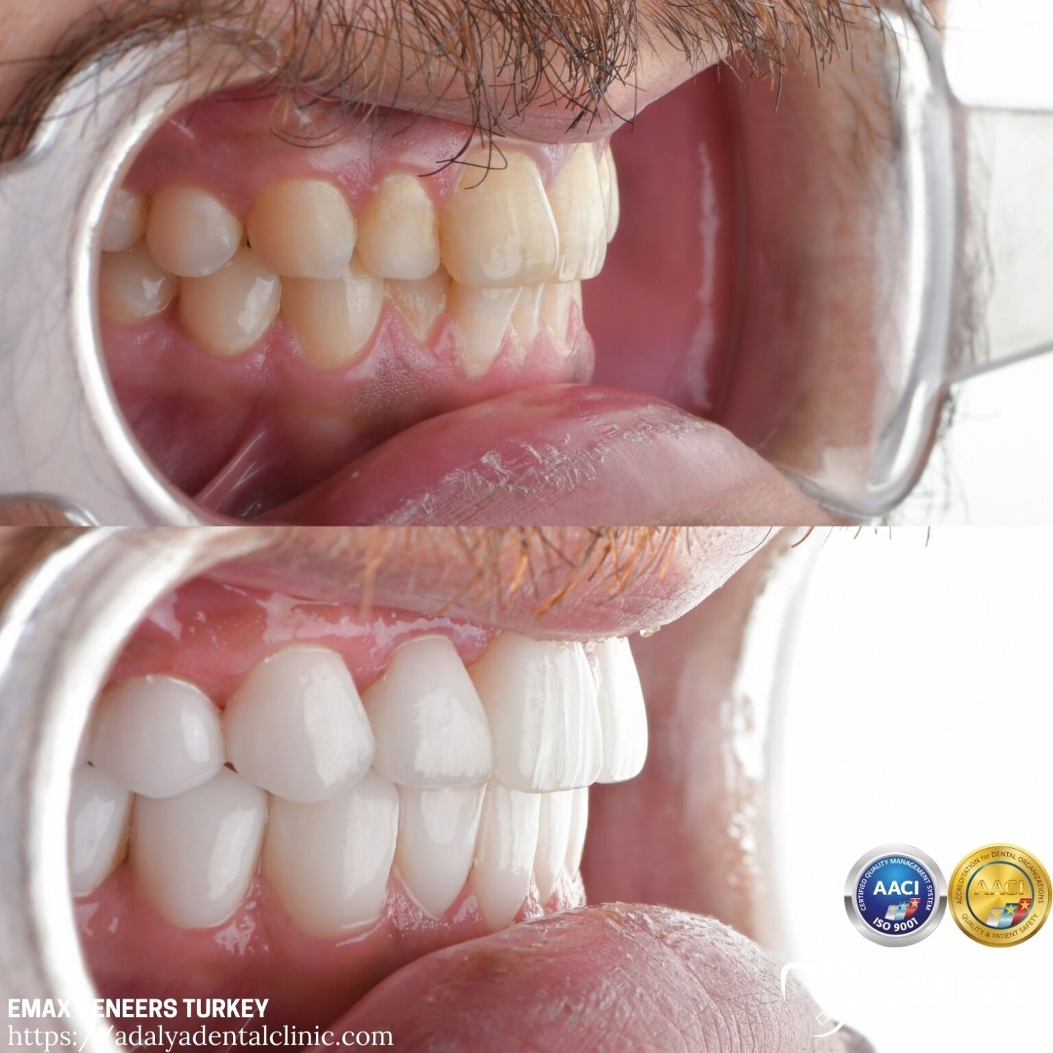 Emax Veneers Turkey Price 2025 - High Quality Veneer in Antalya