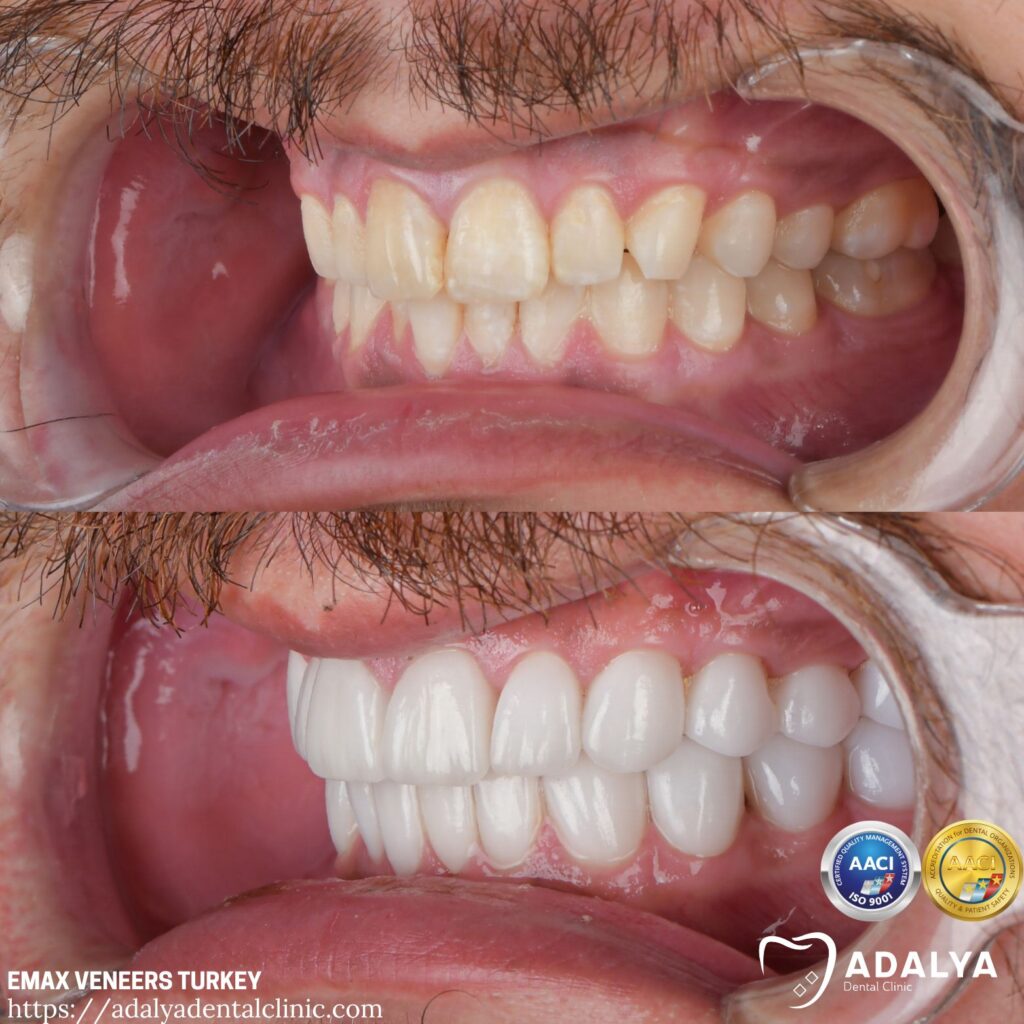 Emax Veneers Turkey Price 2025 - High Quality Veneer in Antalya