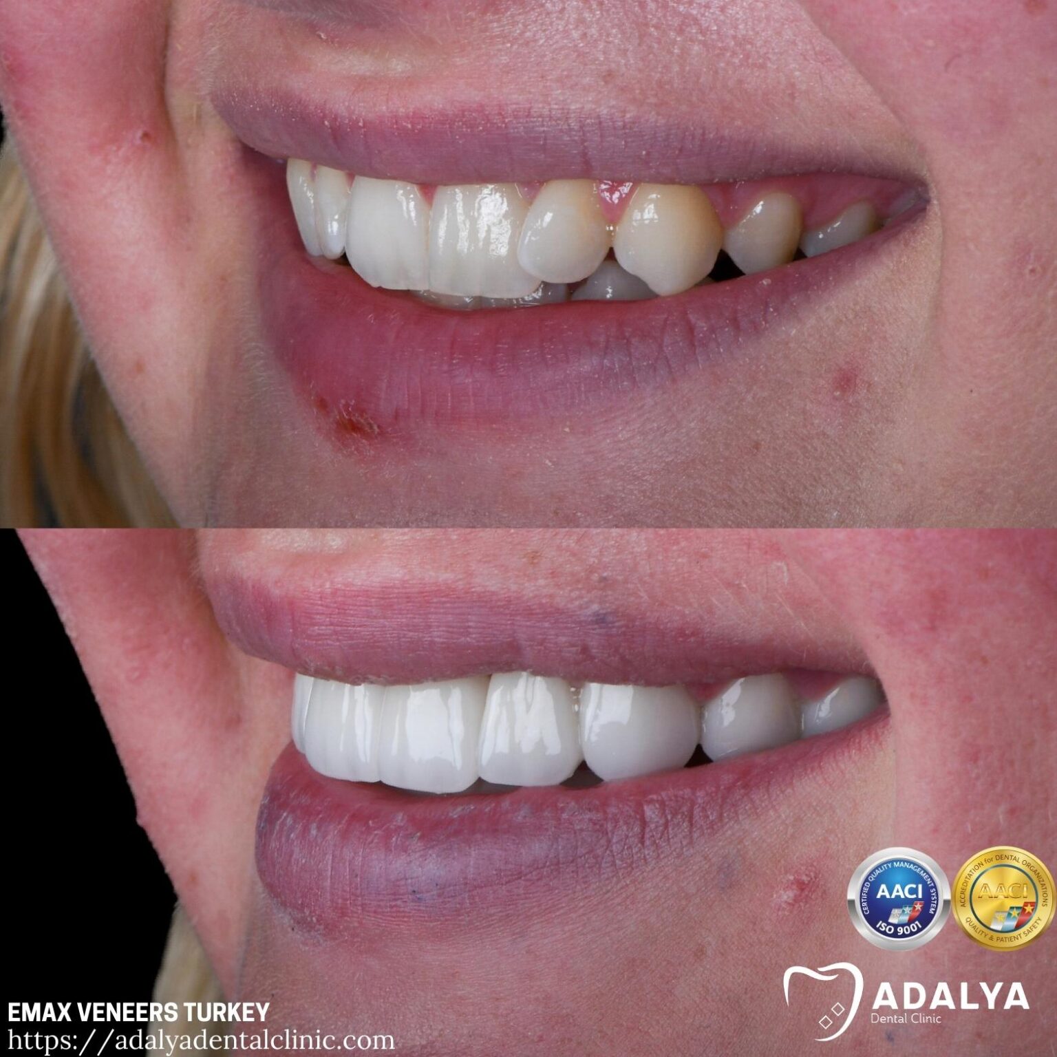 Emax Veneers Turkey Price 2025 - High Quality Veneer in Antalya