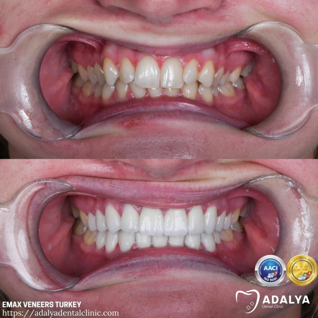 Emax Veneers Turkey Price 2025 - High Quality Veneer in Antalya