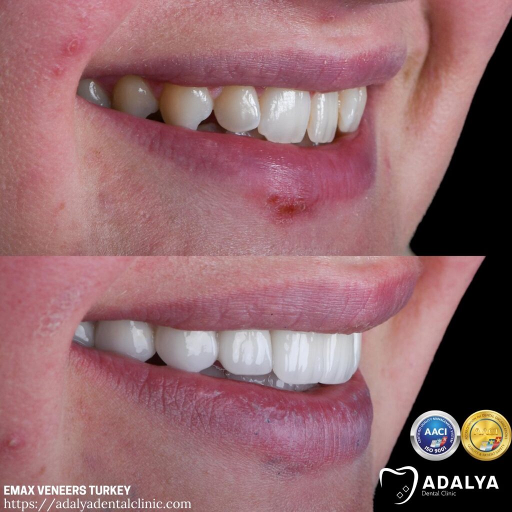 Emax Veneers Turkey Price 2025 - High Quality Veneer in Antalya