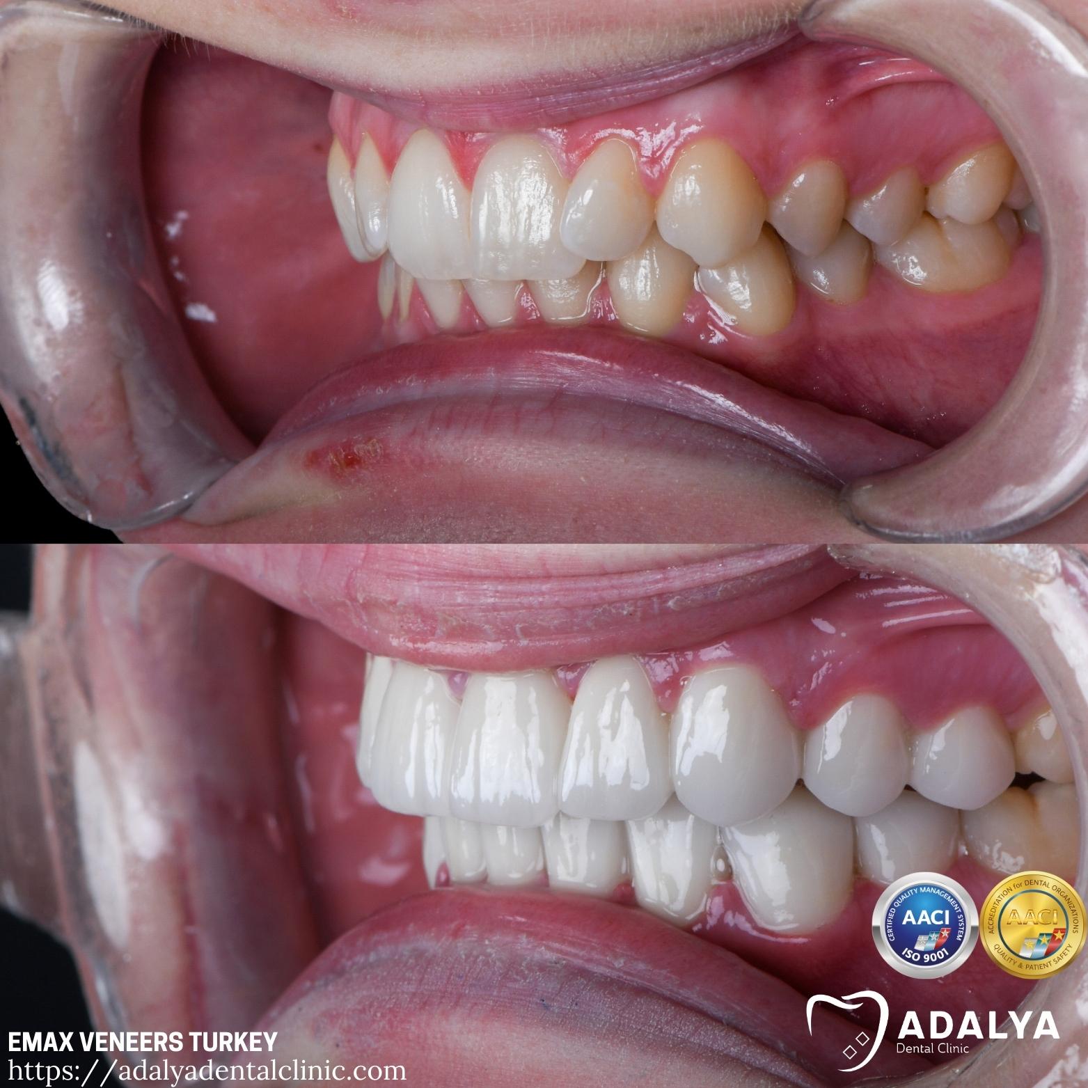 Emax Veneers Türkei Preis 2025 - Hochwertiges Furnier in Antalya