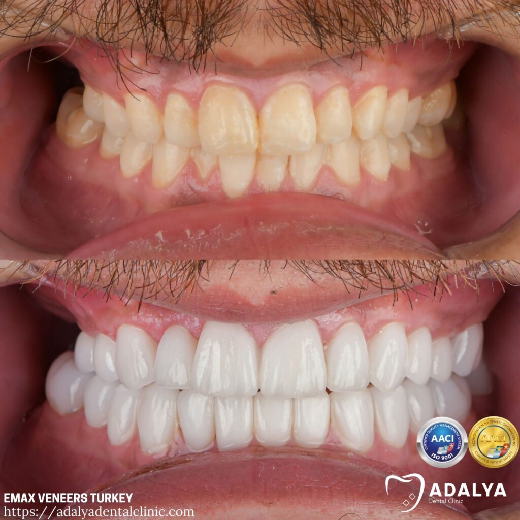 Emax Veneers Turkey Price 2025 - High Quality Veneer in Antalya