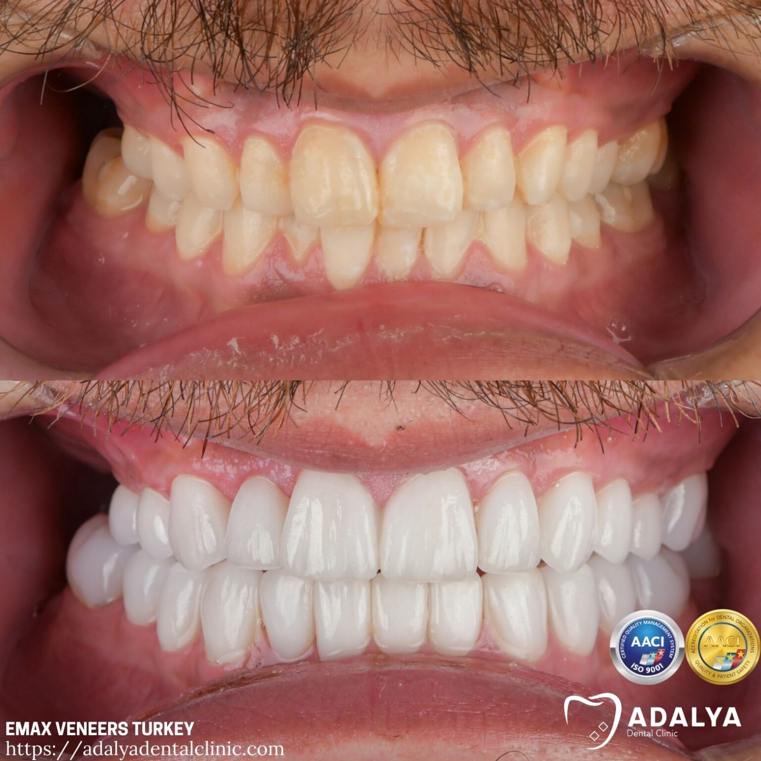 Emax Veneers Turkey Price 2025 - High Quality Veneer in Antalya