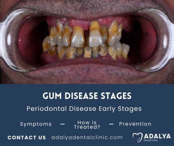 Gum Disease Stages - Periodontal Disease Early Stages | Adalya