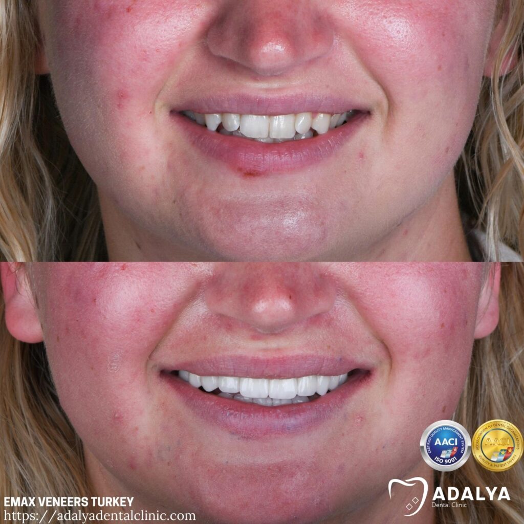 Emax Veneers Turkey Price 2025 - High Quality Veneer in Antalya