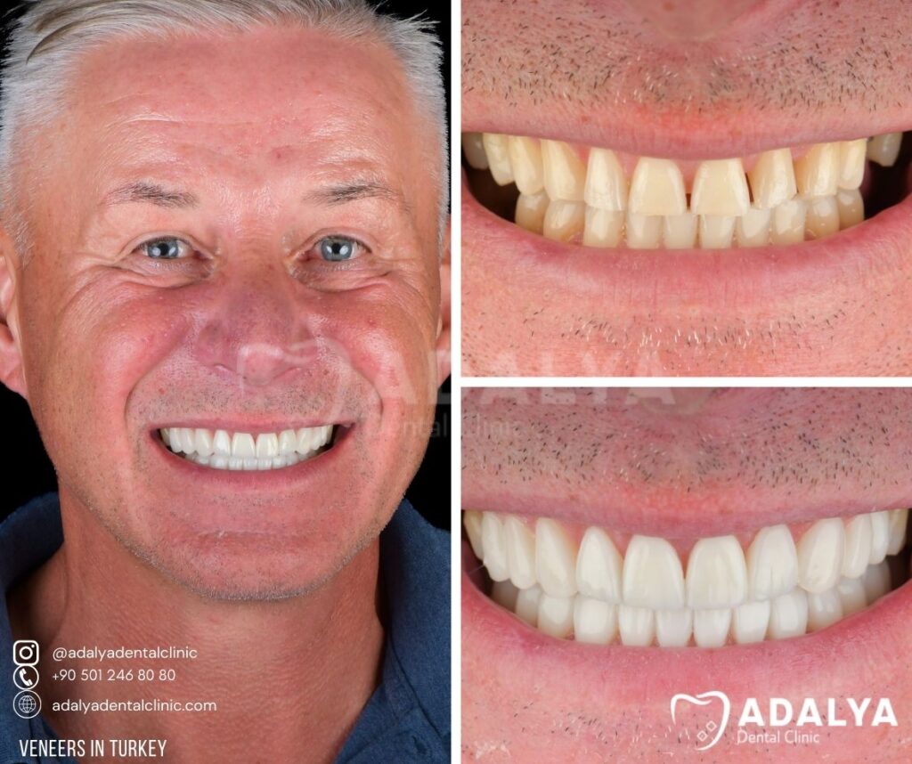 Cost of Veneers in Turkey 2025 | Porcelain Teeth Prices, Reviews