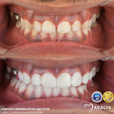 Composite Bonding Before and After - Adalya Dental Clinic