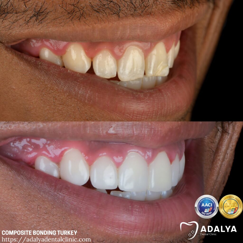 Composite Bonding Before and After - Adalya Dental Clinic
