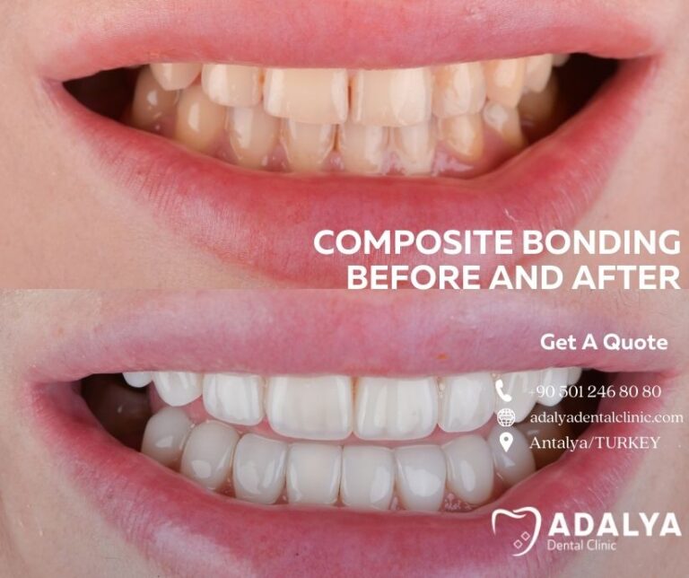 Composite Bonding Before and After - Adalya Dental Clinic