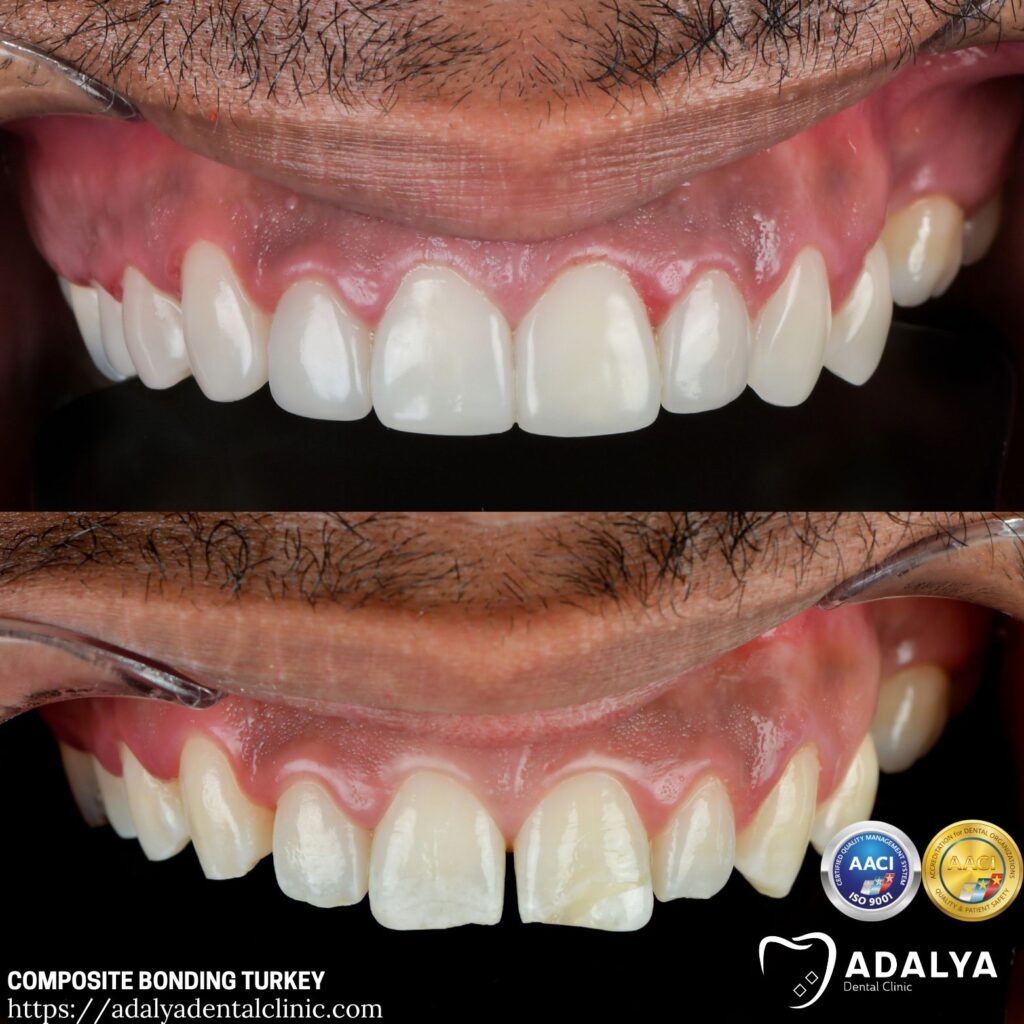 Composite Bonding Before and After - Adalya Dental Clinic